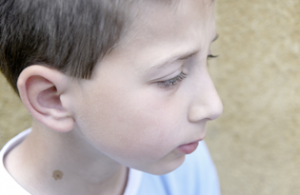 Types of Birthmarks and How to Identify Them - Charlotte Parent