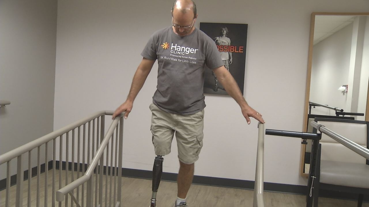 Cutting Edge Technology Helps Local Amputee - Fox21Online